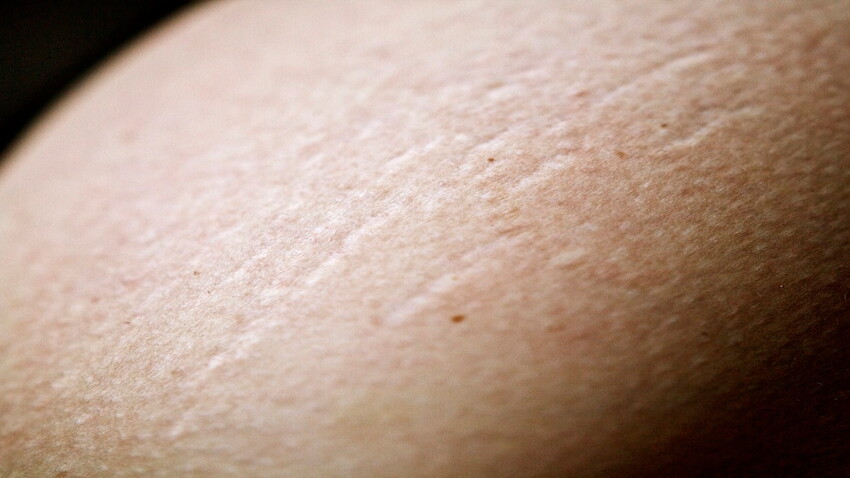 #ThighReading : la hashtag qui célèbre les vergetures : Femme Actuelle ...