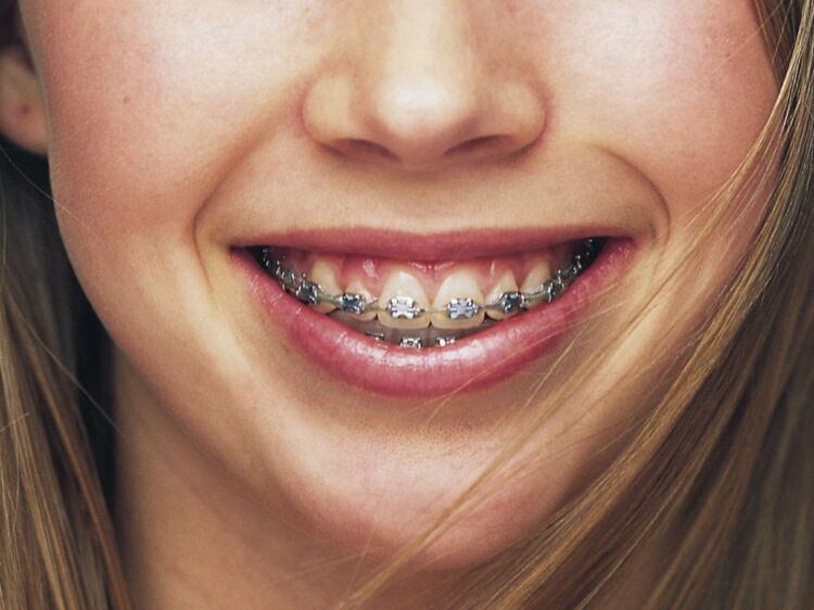 Les différents appareils dentaires pour enfants : Femme Actuelle Le MAG