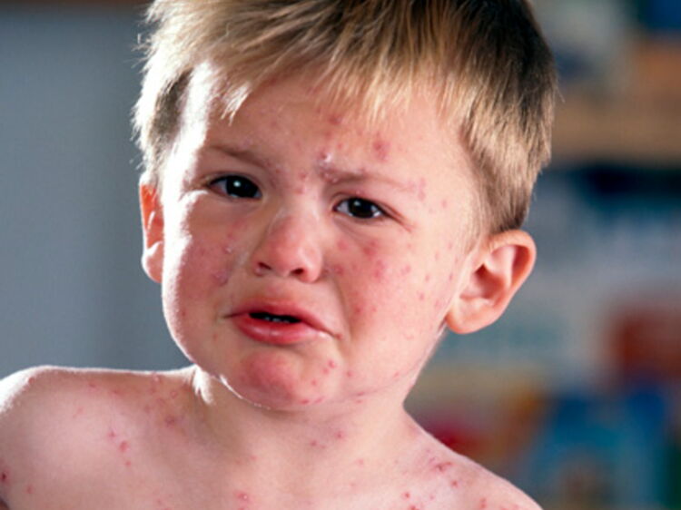 Alerte à la varicelle dans sept régions françaises : Femme Actuelle Le MAG