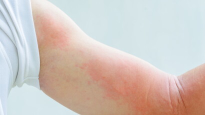 Intertrigo : quels sont les causes et les traitements de cette ...