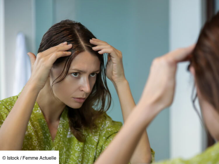 Début de calvitie : les signes à reconnaître et les différentes ...