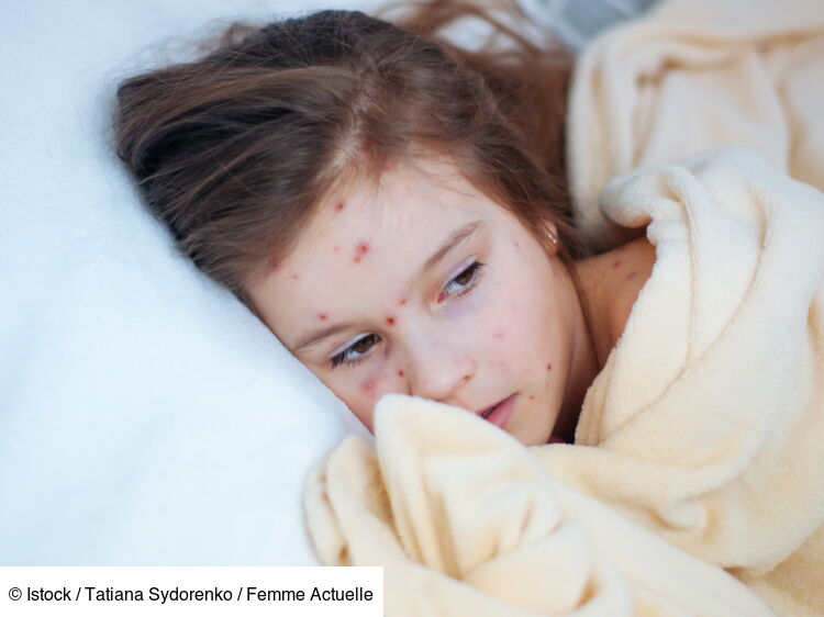 La varicelle : symptômes, traitement et prévention : Femme Actuelle Le MAG