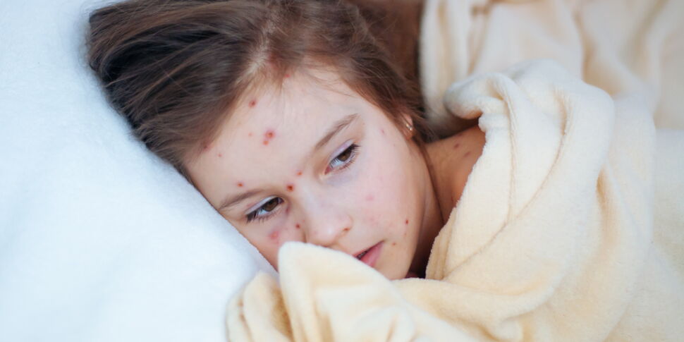 La varicelle : symptômes, traitement et prévention : Femme Actuelle Le MAG