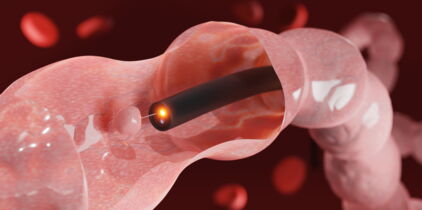 Polype : définitions, causes, symptômes et traitement : Femme Actuelle ...