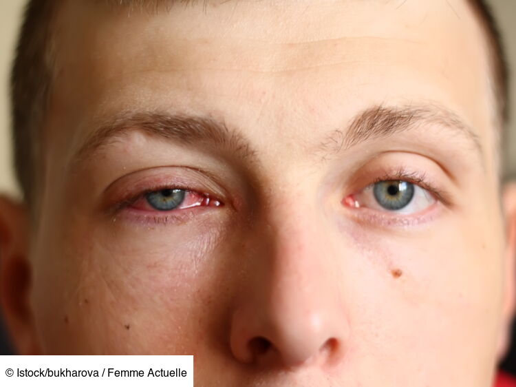 Conjonctivite : contagion, symptômes, durée, traitements : Femme ...