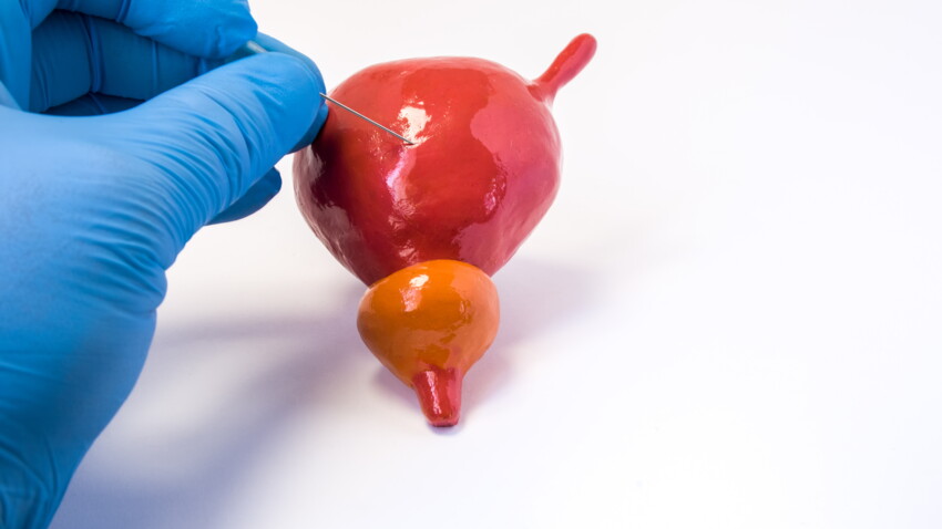 Cystoscopie : intérêt, déroulement et prise en charge de l'examen ...