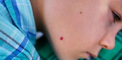 Angiome : définition, causes, comment le reconnaître : Femme Actuelle ...