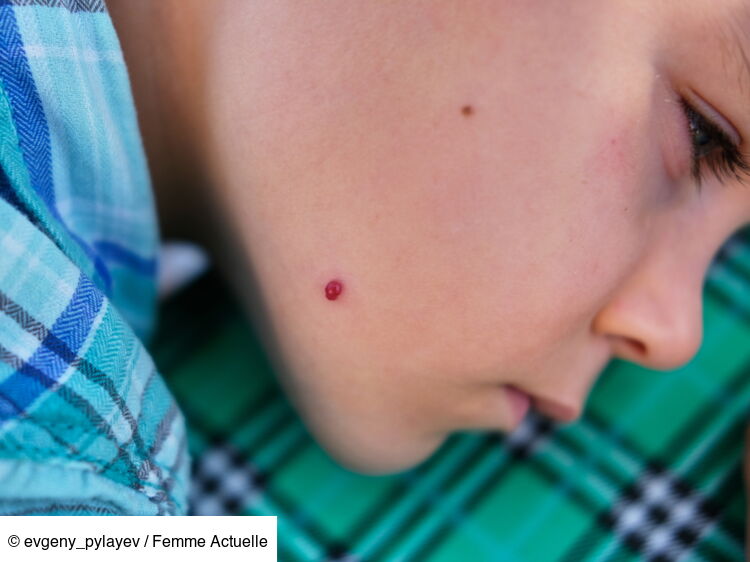 Angiome : définition, causes, comment le reconnaître : Femme Actuelle ...