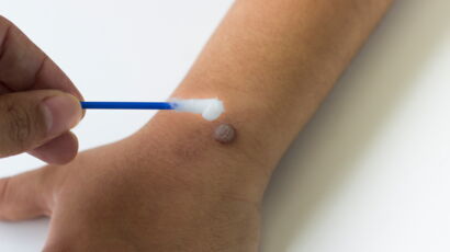 Vrai / Faux : 10 idées reçues sur les verrues : Femme Actuelle Le MAG