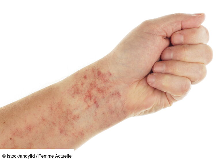 Purpura : différents types, symptômes à reconnaître, traitements ...