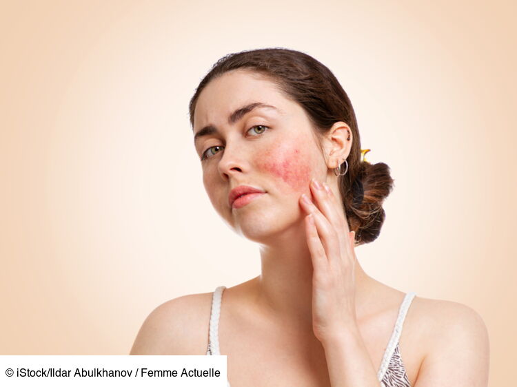 Couperose : causes, traitements et différences avec la rosacée : Femme ...