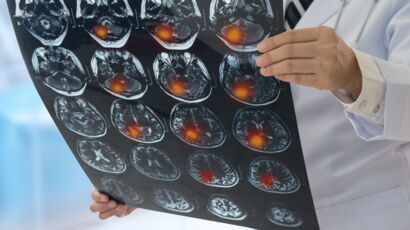 Adénome : symptômes, traitements et différences avec un nodule : Femme ...