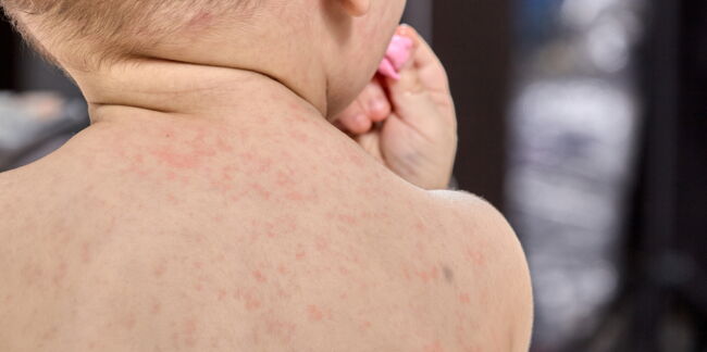 Roséole : comment reconnaître les symptômes chez le bébé et l'enfant ...