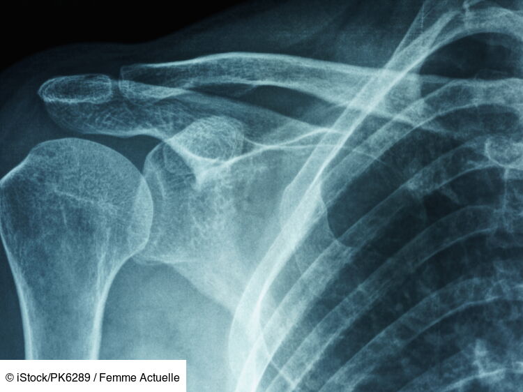 Capsulite rétractile (épaule gelée) : causes, symptômes, traitement ...