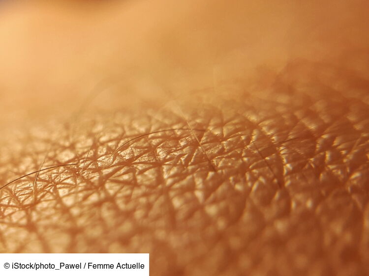 Dermite ocre : définition, symptômes, causes, traitement : Femme ...