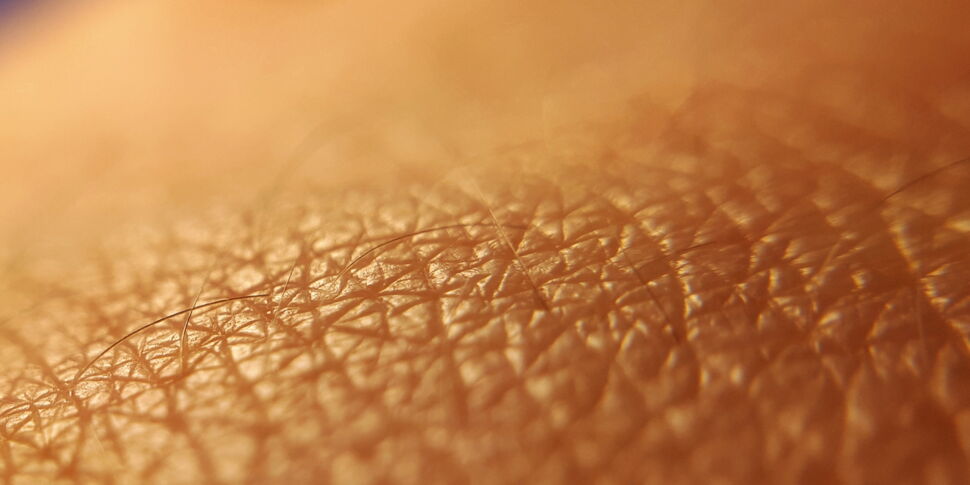 Dermite ocre : définition, symptômes, causes, traitement : Femme ...