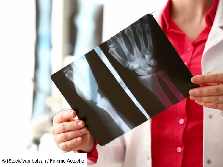 Ostéopénie : quels sont les symptômes et les traitements de cette ...