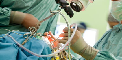 Trépanation : définition, causes, histoire et séquelles de cet acte ...