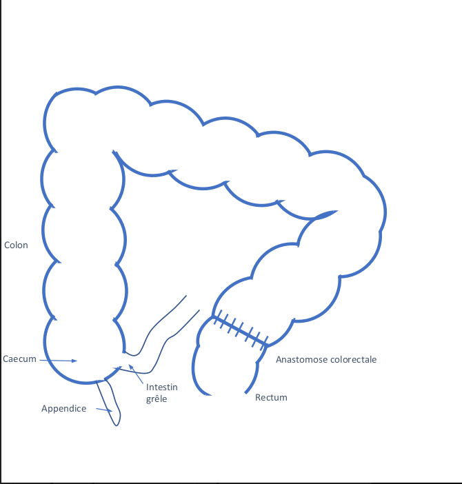 Sigmoïdectomie : technique chirurgicale, déroulement et conséquences de ...