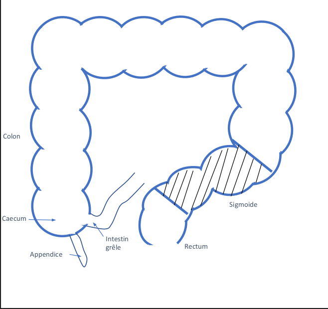 Sigmoïdectomie : technique chirurgicale, déroulement et conséquences de ...