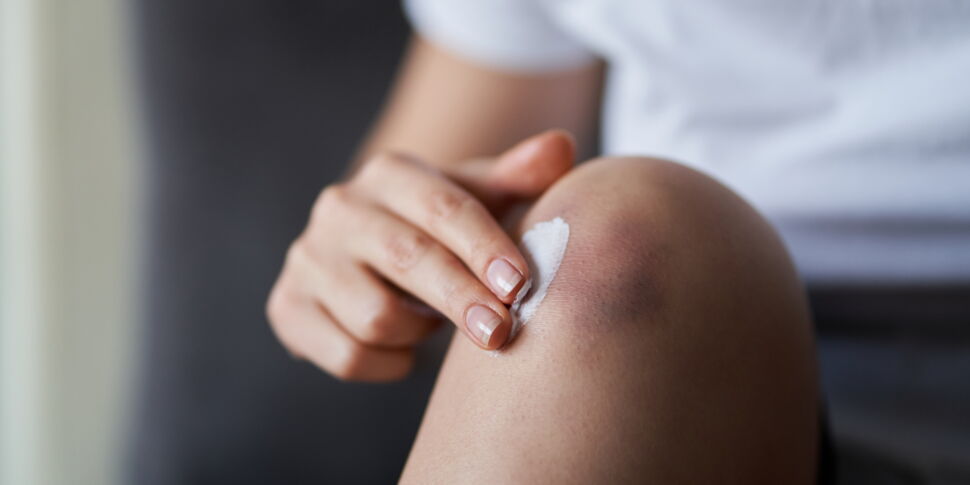 Ecchymose : causes, comment les reconnaître, différence avec hématome ...