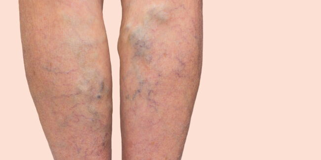 Insuffisance veineuse : causes, symptômes, complications, risques ...