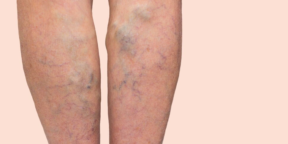 Insuffisance veineuse : causes, symptômes, complications, risques ...
