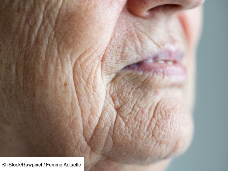 Cutis laxa : symptômes, diagnostic, évolution de cette maladie de la ...