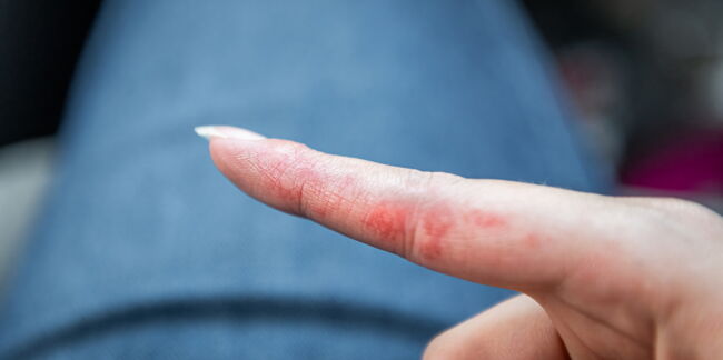 Eczema bulleux : causes, symptômes, contagion, traitement : Femme ...