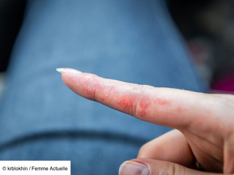 Eczema bulleux : causes, symptômes, contagion, traitement : Femme ...