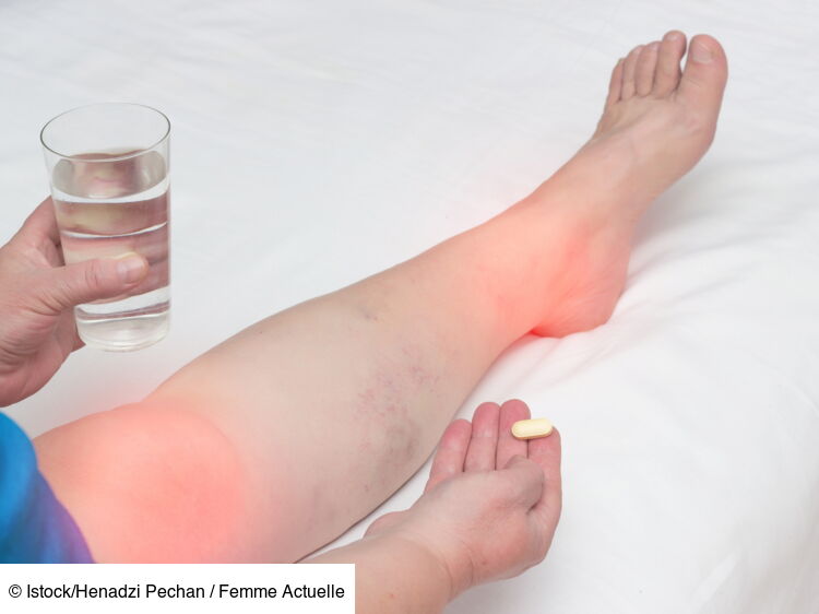 Lymphœdème : causes, symptômes, risques, traitement : Femme Actuelle Le MAG