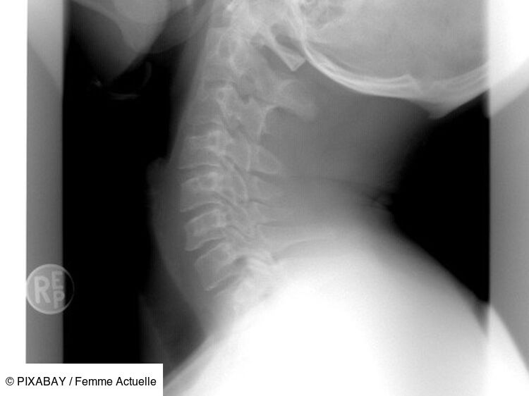 Uncodiscarthrose : diagnostic, symptômes, opération, traitement : Femme ...