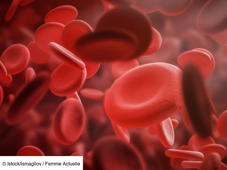 Cryoglobulinémie : définition, type, symptômes, traitement : Femme ...