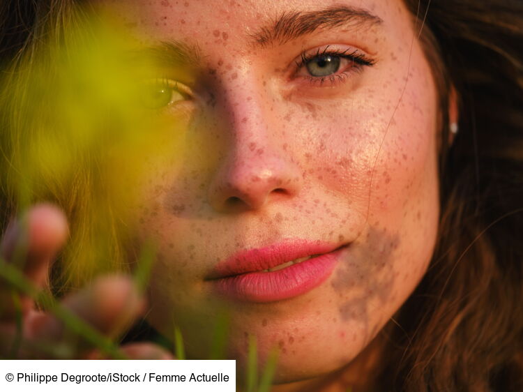 Comment sublimer ses taches de rousseur ? : Femme Actuelle Le MAG