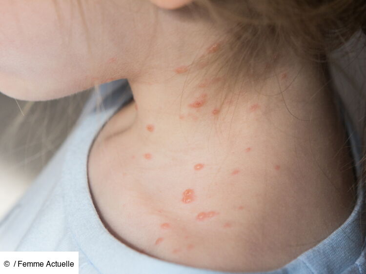 Varicelle : quelle est la période de contagion de cette maladie ...