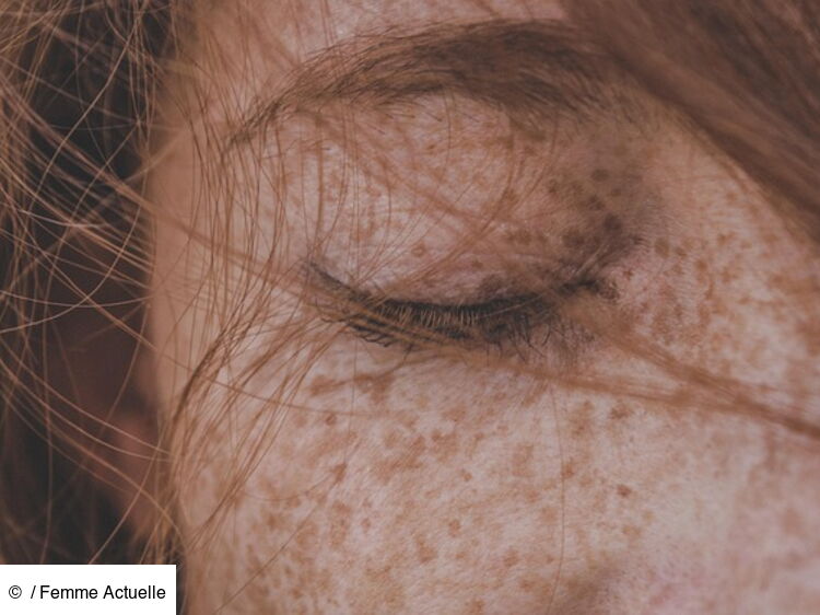 Quels sont les différents types de grain de beauté ? : Femme Actuelle ...