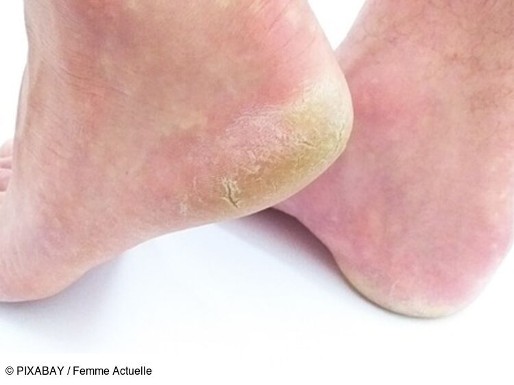 Ketoderm (crème, gel) : indications, posologie, mode d'application et ...