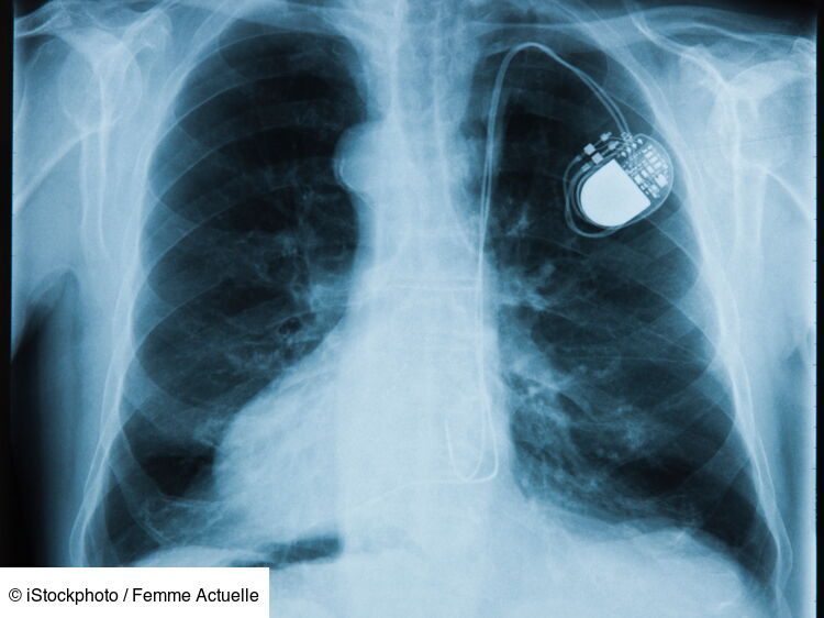 Quelles précautions prendre après la pose d'un pacemaker ? : Femme ...