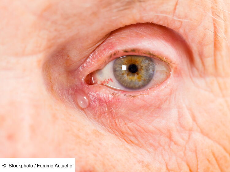 Pourquoi j'ai les yeux qui coulent ? Les conseils de l’ophtalmo : Femme ...