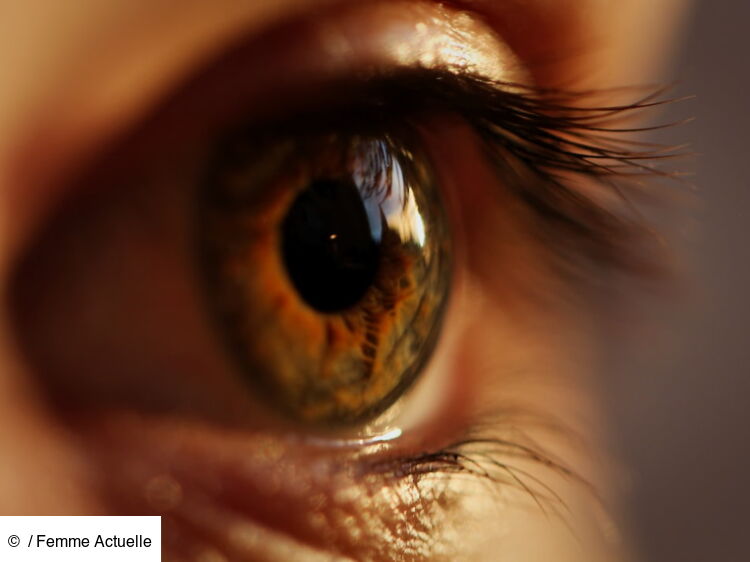 Orgelet à l'œil : comment le reconnaître et le soigner ? : Femme ...