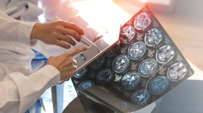 Cancer du nez (fosses nasales et sinus paranasaux) : cause, symptômes ...