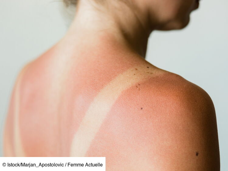 Coup de soleil : que faire pour les éviter et comment les soulager ? : Femme Actuelle Le MAG