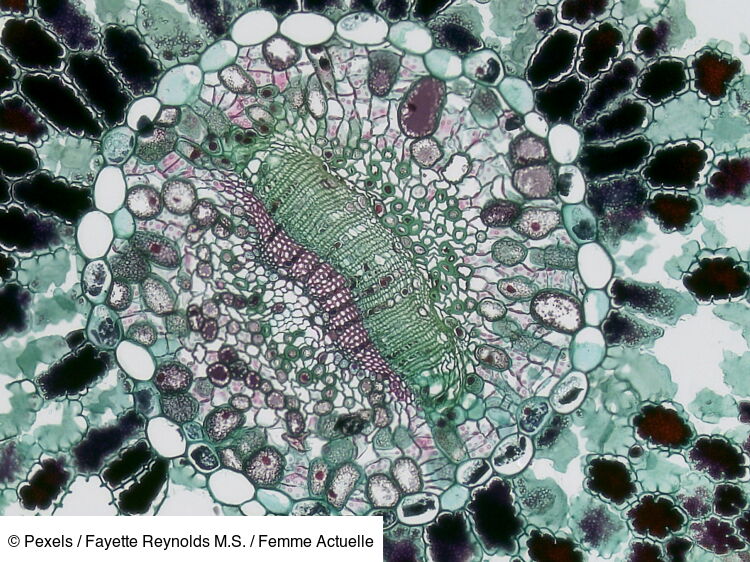Nécrose : causes, symptômes, différents types, traitements : Femme ...