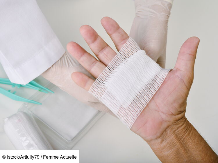 Brûlure du 3ème degré : les précautions à prendre pour favoriser la ...