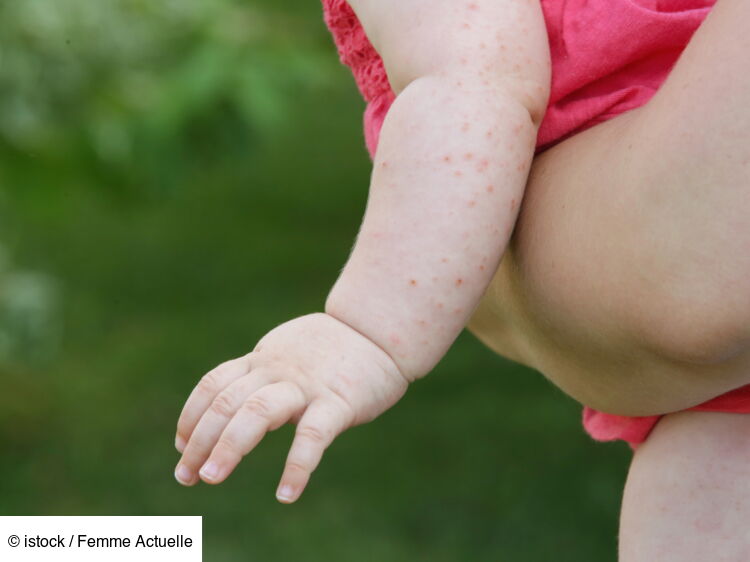 Boutons de chaleur chez bébé : comment les reconnaître et faut-il s ...