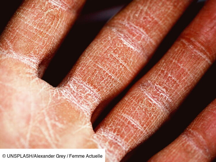 Eczéma ou gale : comment faire la différence ? : Femme Actuelle Le MAG