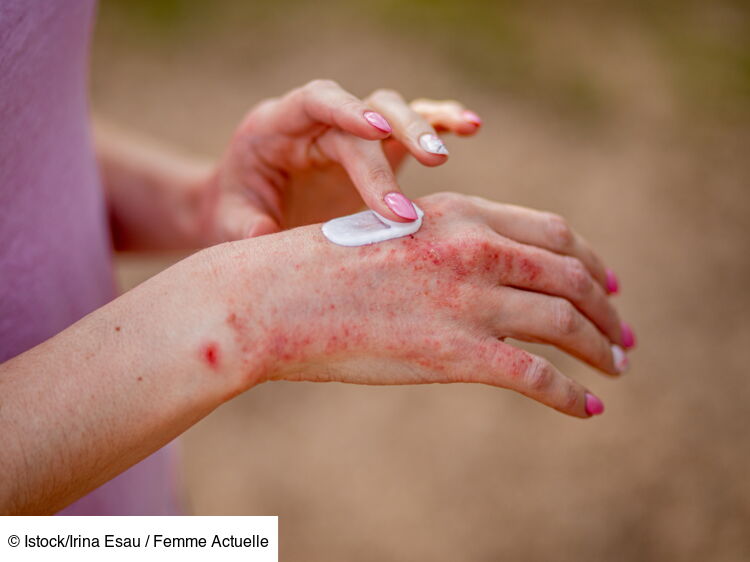 Cortisone en crème : indications, prescription, effets secondaires ...