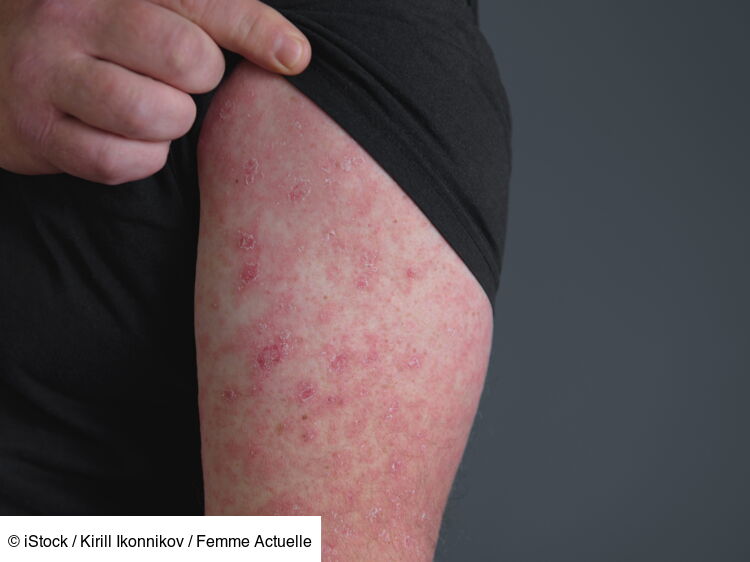 Dermohypodermite : quels sont les symptômes et les causes de cette ...