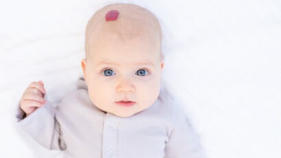 Angiome de bébé : causes, traitements, faut-il s'inquiéter ? : Femme ...