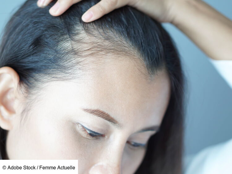 Alopécie ou chute sévère des cheveux : un dermatologue fait le point ...